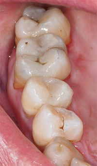 Inlays, onlays et overlays - Cabinet dentaire à Libourne